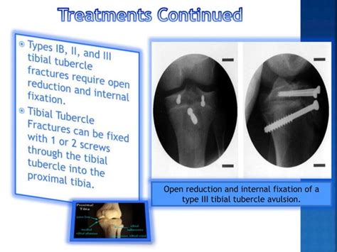 Tibial Tubercle Avulsion Fracture Powerpoint 1 Pptx