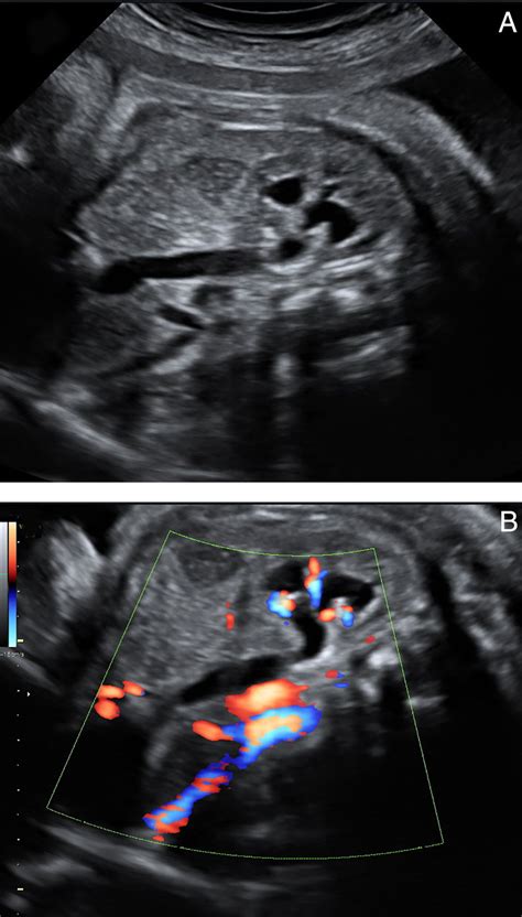 Interobserver Reliability Of The Antenatal Consensus Classification