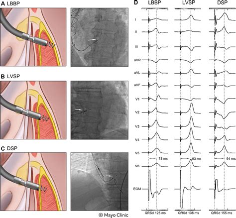 Left Bundle Branch Pacing Vs Ventricular Septal Pacing For Cardiac Resynchronization Therapy