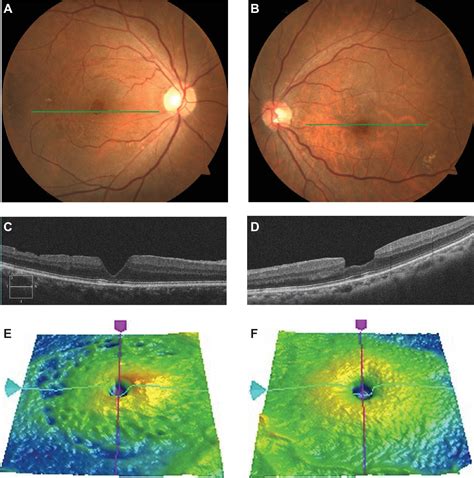 Vitrectomy Membrane Peeling