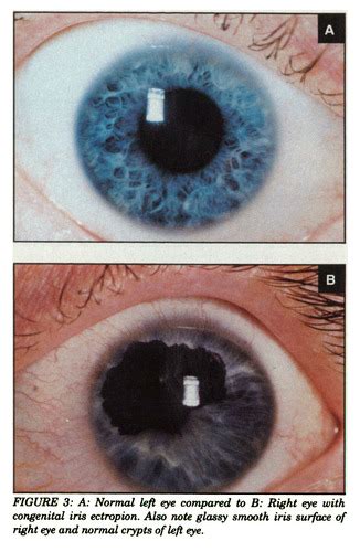 Ectropion Uveae