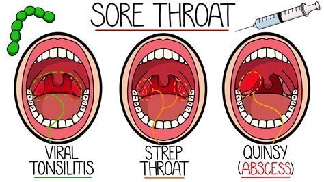 How Soon Can You Swab For Strep Throat