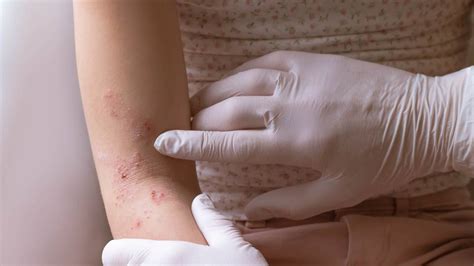 Pearls For Management Of Pediatric Atopic Dermatitis Medical Education