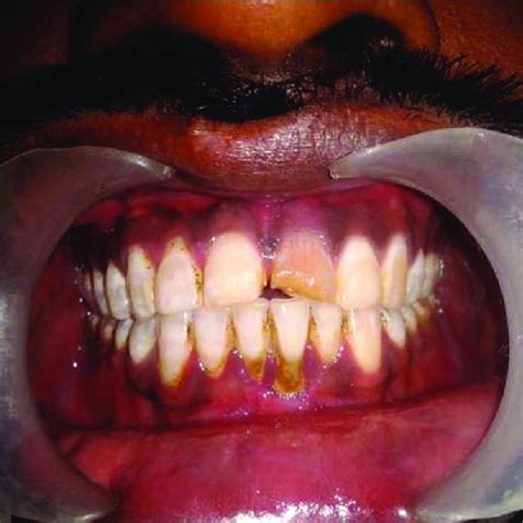 Intraoral Periapical Radiographs Showing Multiple Talon Cusps
