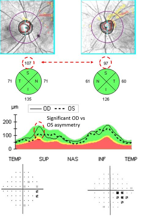 Utilizing Oct For Glaucoma Diagnosis And Management