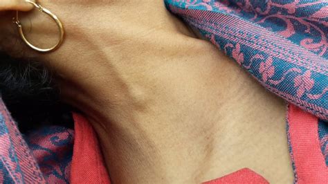 Jugular Vein Distension Distended Veins Raised JVP YouTube