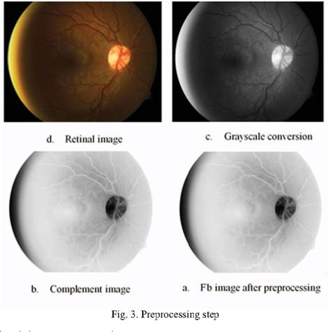 Figure 3 From Automated Microaneurysms Detection In Fundus Images Using