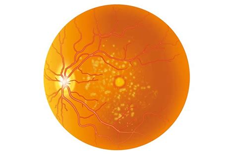 What Are Optic Nerve Drusen And How Do They Affect Vision