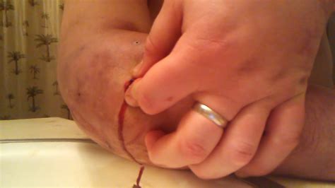 Lancing And Draining An Abscess Youtube