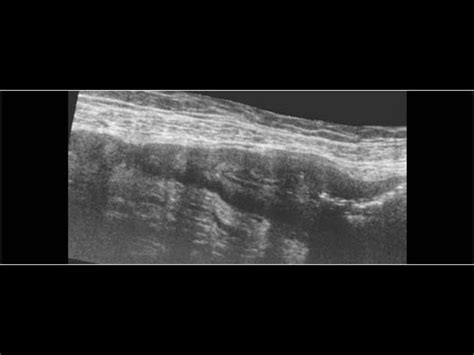 Abdomen And Retroperitoneum 16 Gastrointestinal Tract Case 162