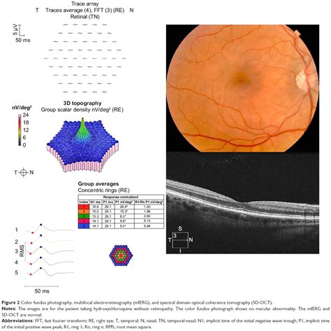 Scotoma Analysis Of 10 2 Visual Field Testing With A White Target In S Opth