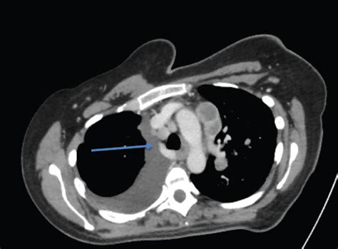 Ct Chest Showing Involvement Of The Right Lower Paratracheal Lymphnodes