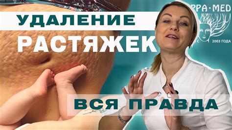 Удаление растяжек лазером Вся правда о процедурах Профилактика Youtube
