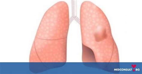 Какво представлява дребноклетъчния рак на белия дроб — Medconsult Bg