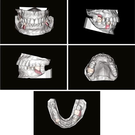 Appearance Of Rpds With Peek Frameworks A Maxillary Rpd Before