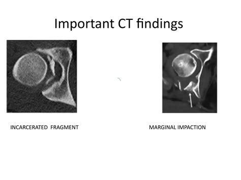 Imaging And Classification Of Acetabular Fracturespptx