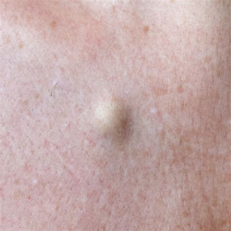 Cyst Removal Gloucester Proskin Clinic And Health Uk