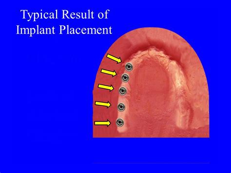 Soft Tissue Management Courses And Lectures Pedicle Graft Procedure