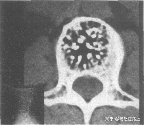椎体血管瘤也可以用微创介入方法治疗 知乎