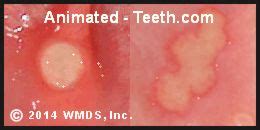 Canker Sore On Lip Vs Herpes