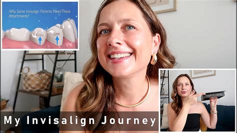 My Invisalign Journey How Invisalign Work My Total Dental Cost And