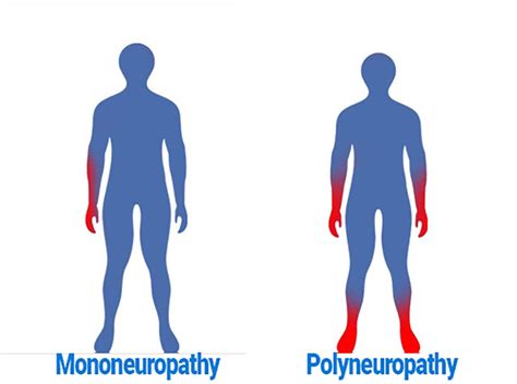 Causes And Types Polyneuropathy Physiotherapy Clinic In Abuja
