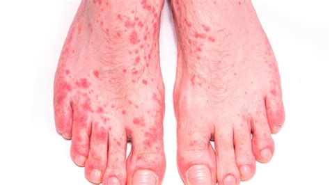 Maculopapular Rash Hiv Symptoms