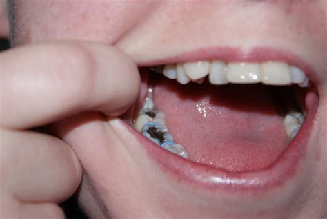 How Do They Put Spacers In Your Teeth At Shirley Pearson Blog