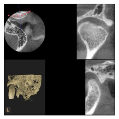 Osteophyte Of Condyle As Seen In Dvt Download Scientific Diagram