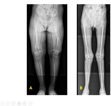 Pamidronate Response In A Novel Biallelic Creb3l1 Gene Mutation Associated Osteogenesis