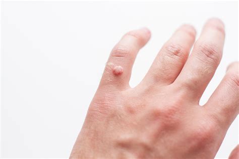 Hpv Healthyd