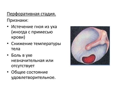 Острый гнойный перфоративный отит особенности течения у детей