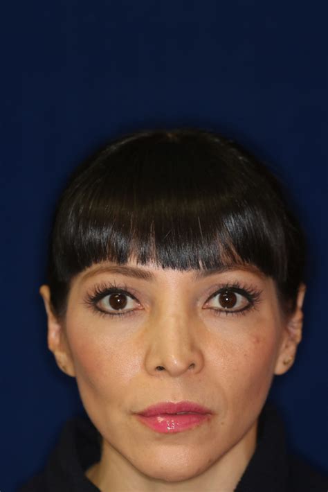Nose Filler Case 21623 Rhinoplasty Nose Surgery Beverly Hills Dr