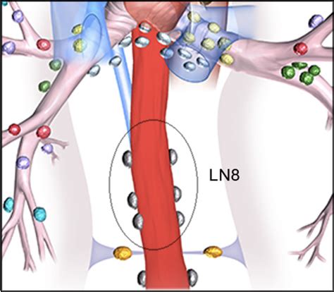 Subcarinal Lymph Node