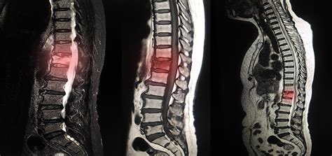 New Jersey Spinal Tumor Treatment Spinal Tumors Surgery Nj
