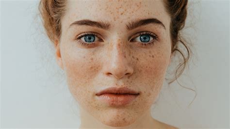 Mole Vs Freckle Whats The Difference