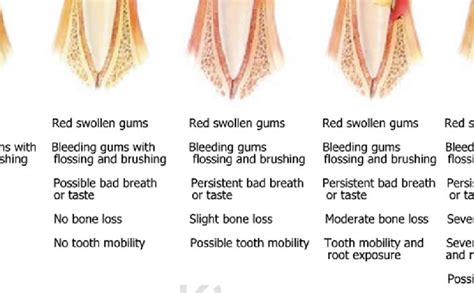 4 Progression Of Periodontal Disease Reprinted With Permission From Download Scientific
