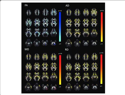Diffusion Tensor Imaging DTI Of Patients With Mild Traumatic Brain