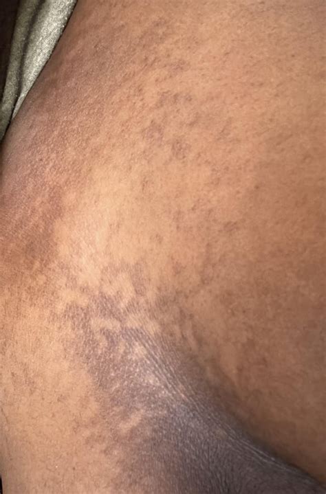 Introduction Rcarpskincondition