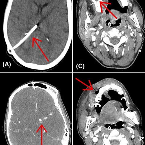 Computed Tomography Ct Scan Revealing Several Characteristic Findings