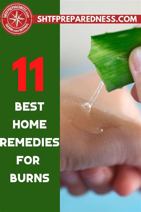11 Best Home Remedies For Burns In 2021 Home Remedies For Burns Burn