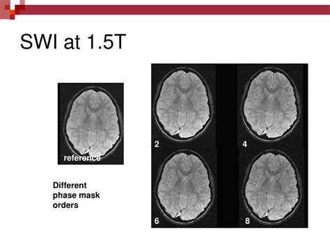 PPT Susceptibility Weighted Imaging SWI PowerPoint Presentation