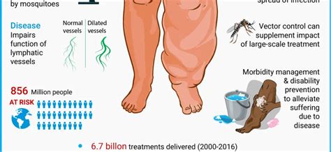 Elephantiasis Causes Symptoms Treatment Healthy Food Near Me