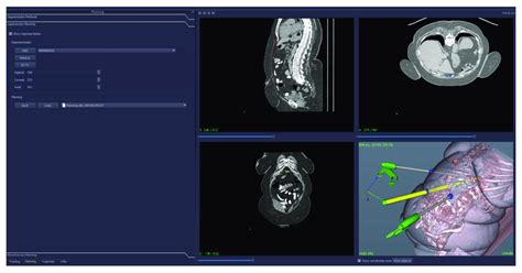 Ct Based 3d Reconstruction Of The Abdomen With Preoperative Instrument Download Scientific
