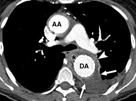 Mdct Angiography Of Thoracic Aorta Endovascular Stent Grafts Pearls