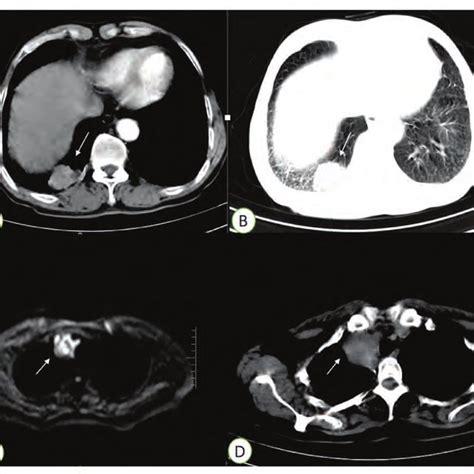 Imaging Data Of Cases A And B Belong To Case 1 The Mass Could Be Seen