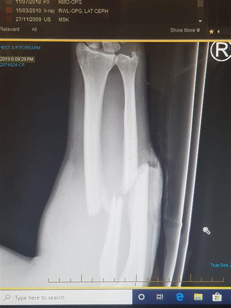 Compound Fracture Im Out Lads R Neverbrokeabone