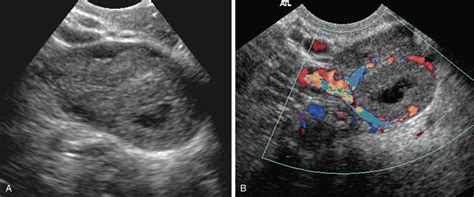 Benign Ovarian Masses Radiology Key