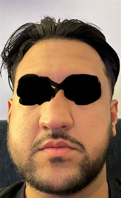 Do I Need Jaw Surgery To Correct The Asymmetry Rjawsurgery