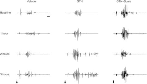 Raw Emg Traces Showing Activity In The Ipsilateral Suprapalpebral
